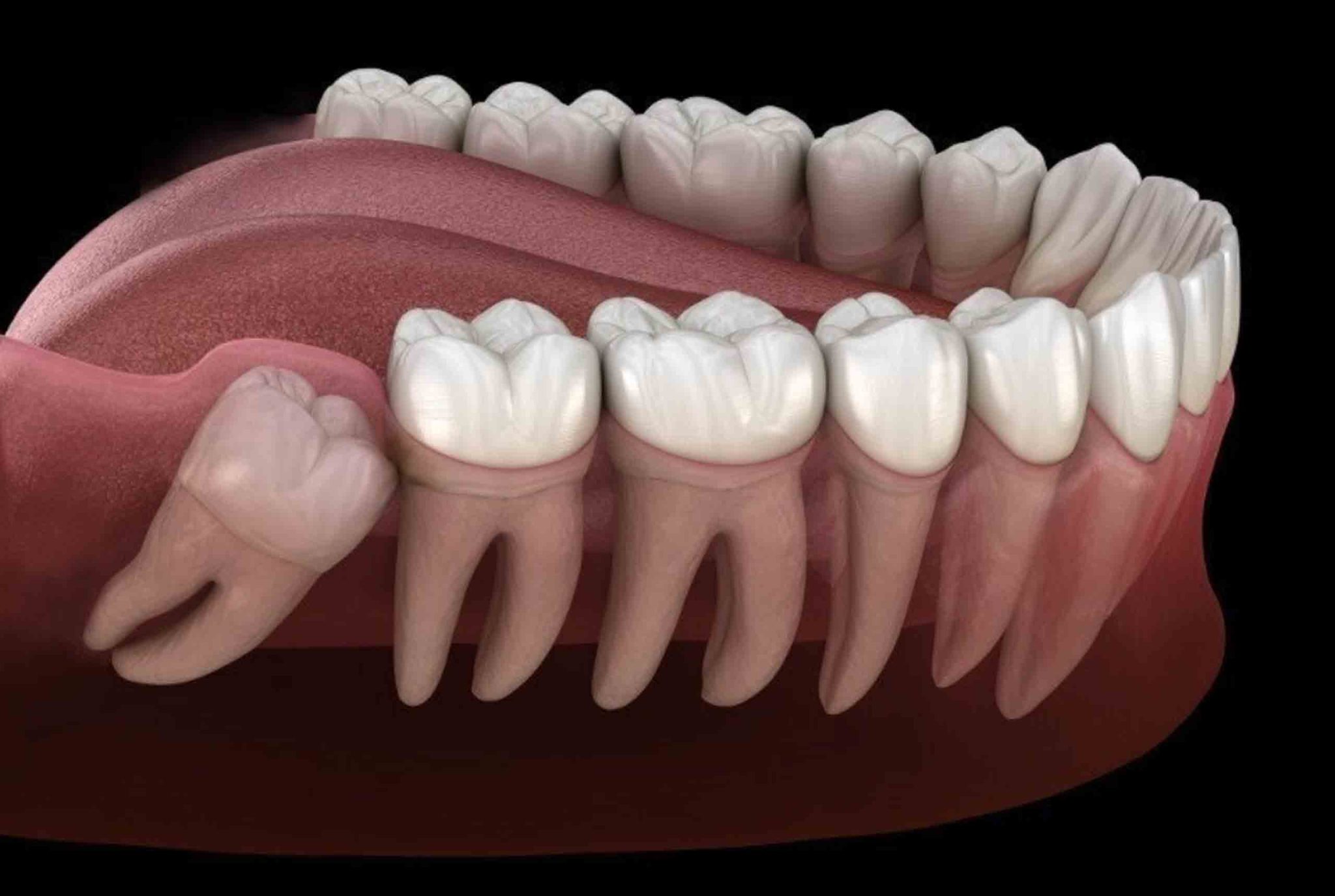 Pembedahan Mulut Minor - klinikpergigiandrsyazwan
